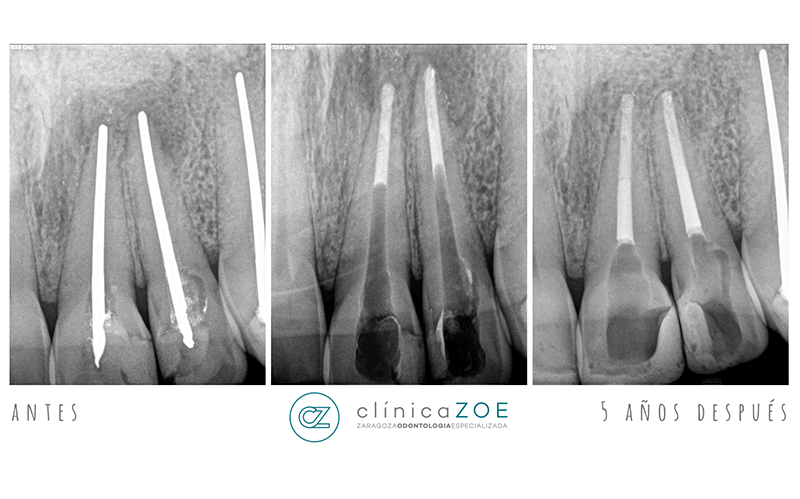 Endodoncia con Apicoformación | Zaragoza Odontología Especializada